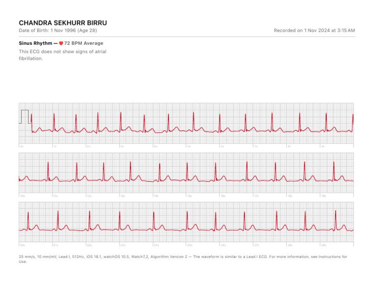 Health - Chandra Sekhurr Birru - Ecg 2024-11-01 at 03.15 | PDF