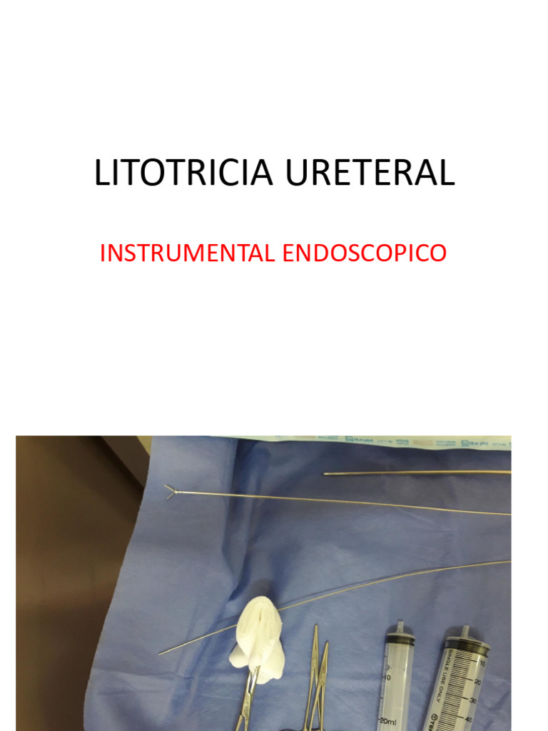Litotricia Ureteral | PDF