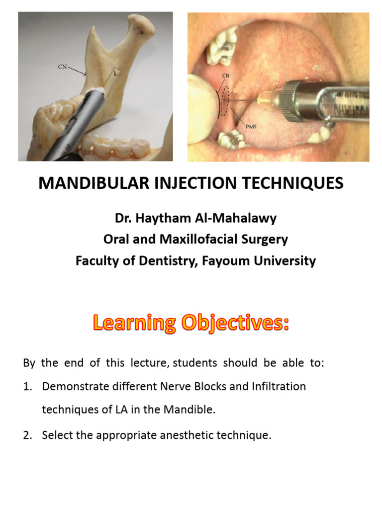 Mandibular Injection Techniques | PDF | Human Anatomy | Human Head And Neck
