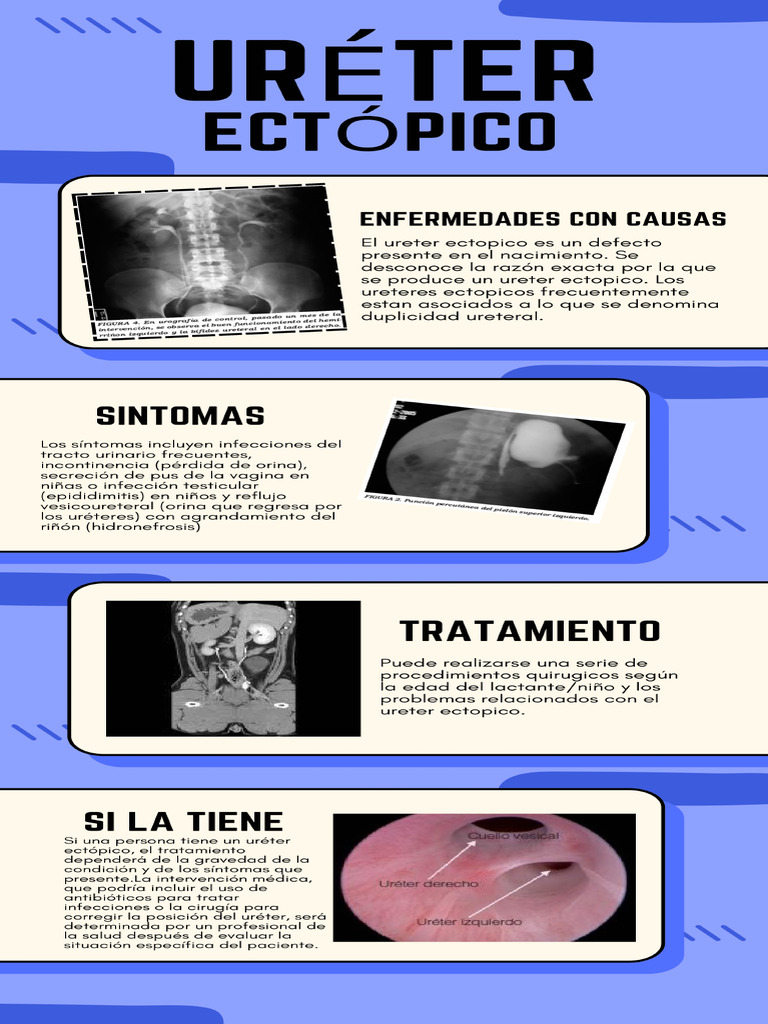 Uréter Ectópico | PDF
