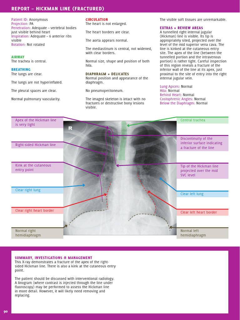 X-ray Reports: Hickman Line & Dextrocardia | PDF | Lung | Heart