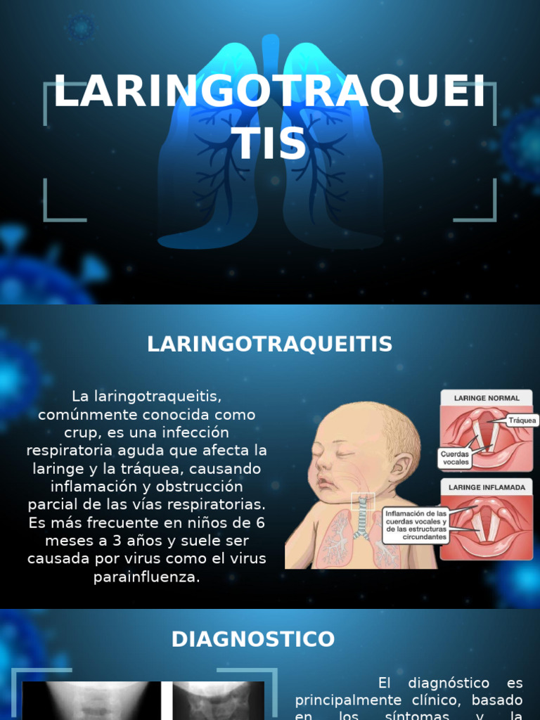 Laringotraqueitis y Otitis | PDF | Epidemiología | Medicina CLINICA