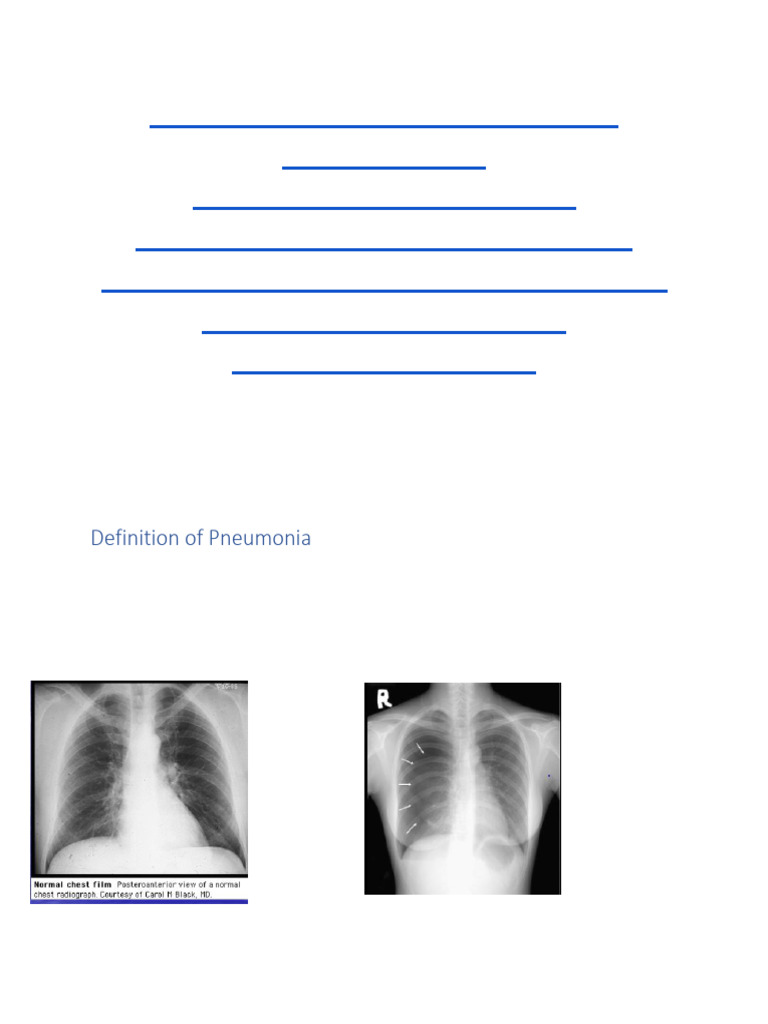 Pneumonia and Its Type and Detail Note On Management | PDF | Pneumonia | Clinical Medicine