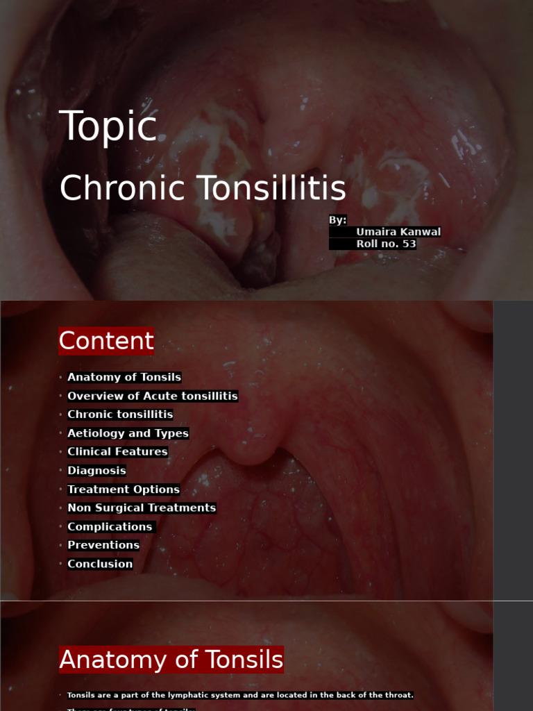 Chronic Tonsillitis Presentation | PDF | Medical Specialties | Diseases And Disorders