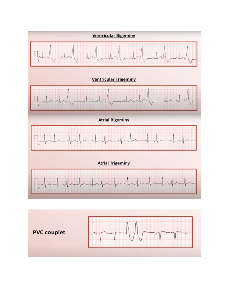 Ekg | PDF