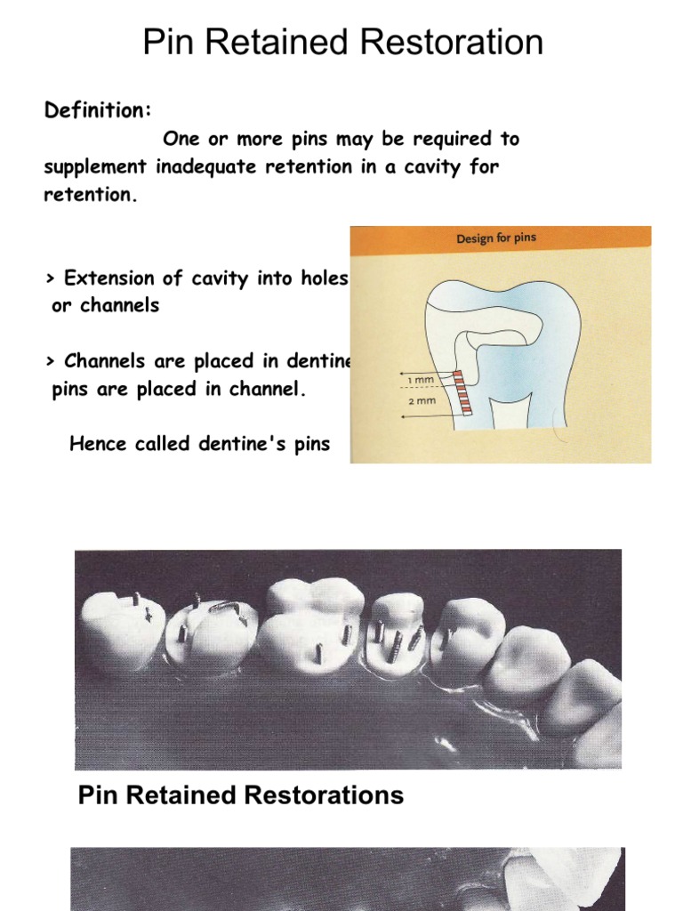 Pin Retained Dental Restorations | PDF | Dentin | Tooth