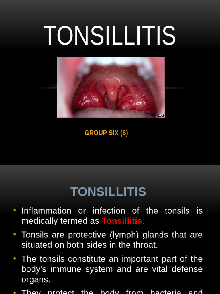 Tonsillitis Group 6 | PDF | Medical Specialties | Diseases And Disorders