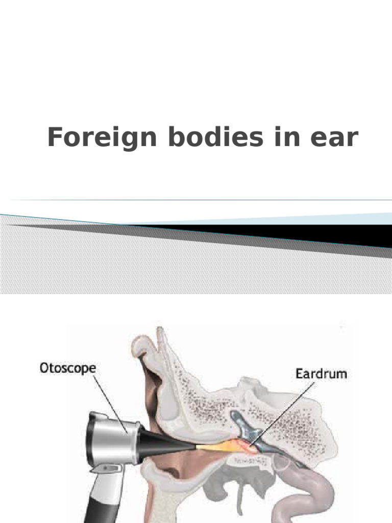 Foreign Bodies in Ear | PDF