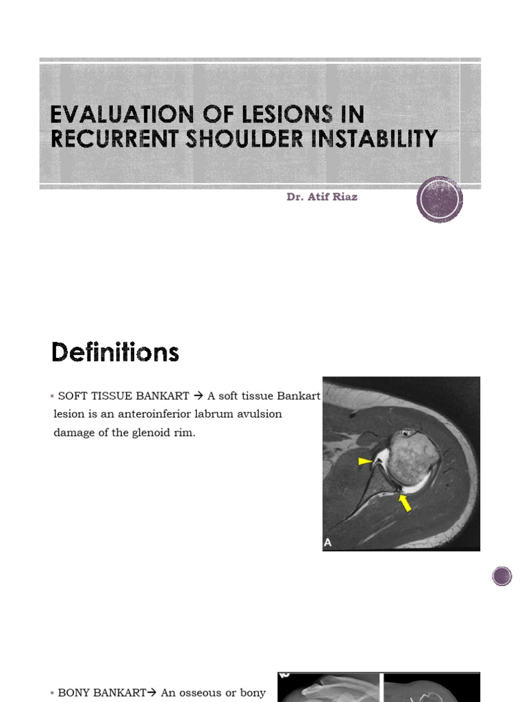 Evaluation of Lesions in Recurrent Shoulder Instability | PDF