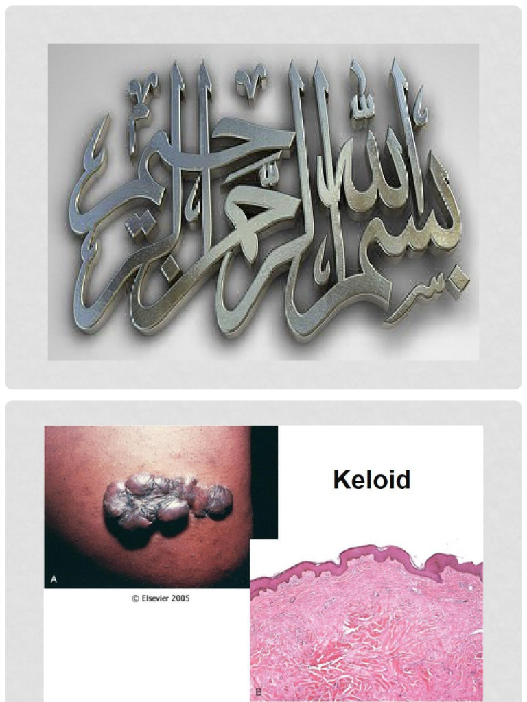 Keloid | PDF