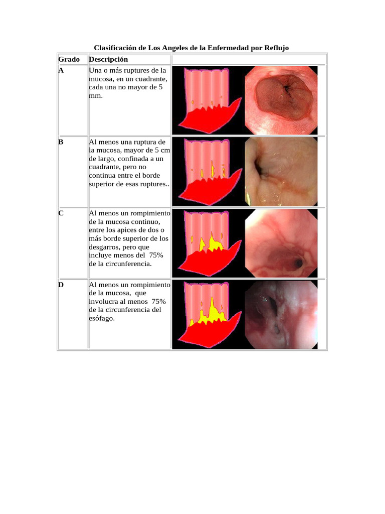 The Los Angeles Classification of Reflux Esophagitis | PDF