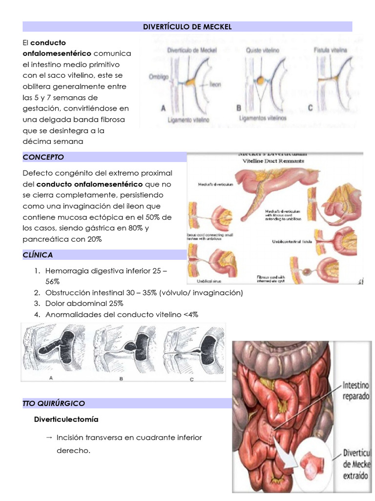 Divertículo de Meckel: Definición y Tratamiento | PDF | Ciencia y ...