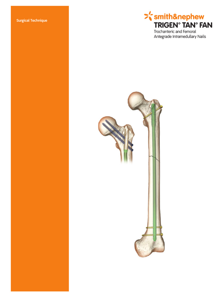 v8 71181611 Revg Trigen Tan-Fan Surgical Technique 0323 | PDF | Screw ...