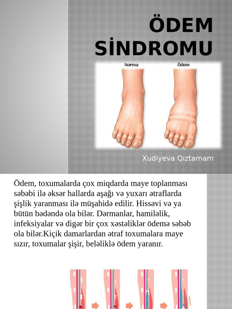 Edema | PDF