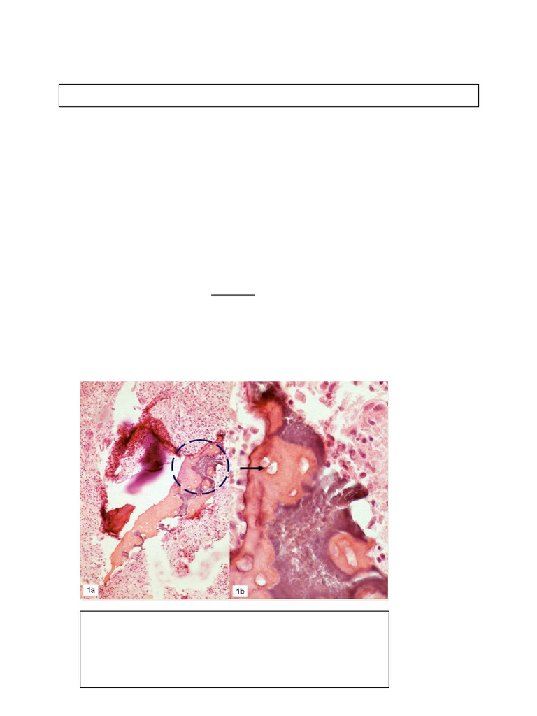 Comprendre le séquestre osseux : définitions et imagerie | PDF | Os ...