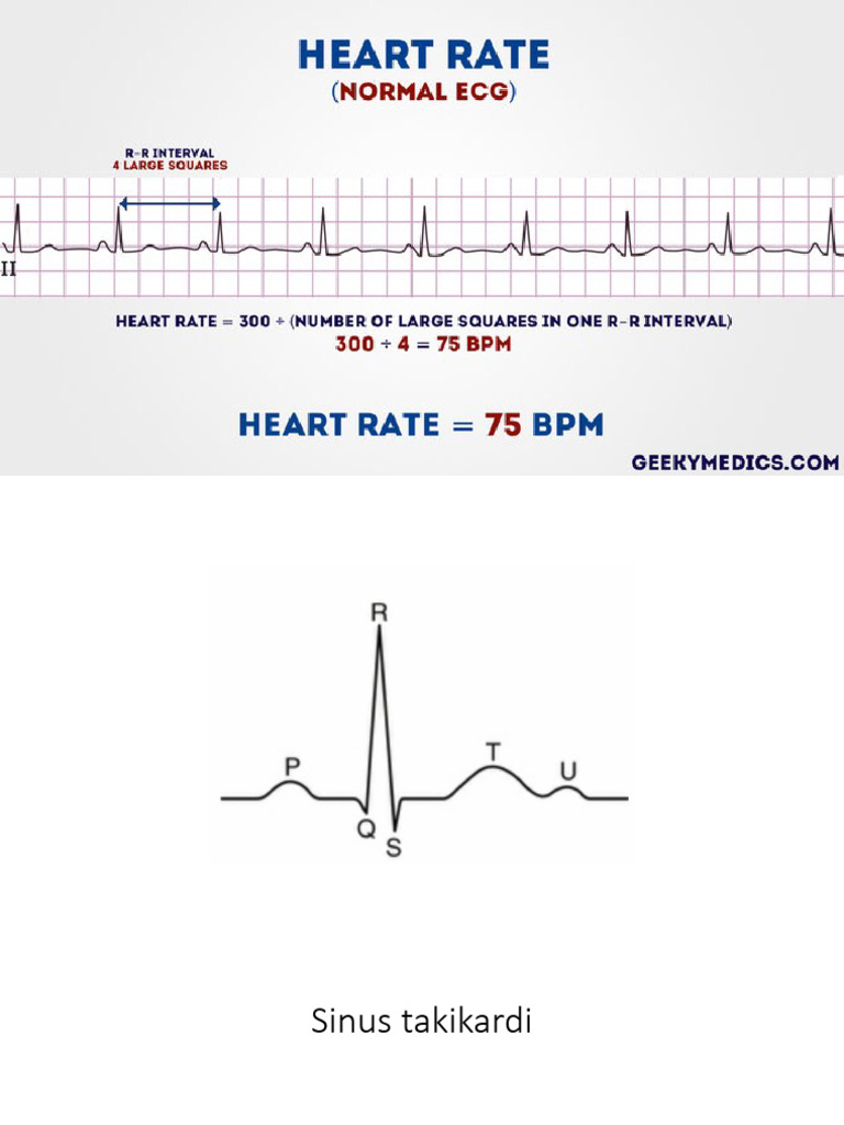 Latihan Ekg - 240403 - 054315 | PDF