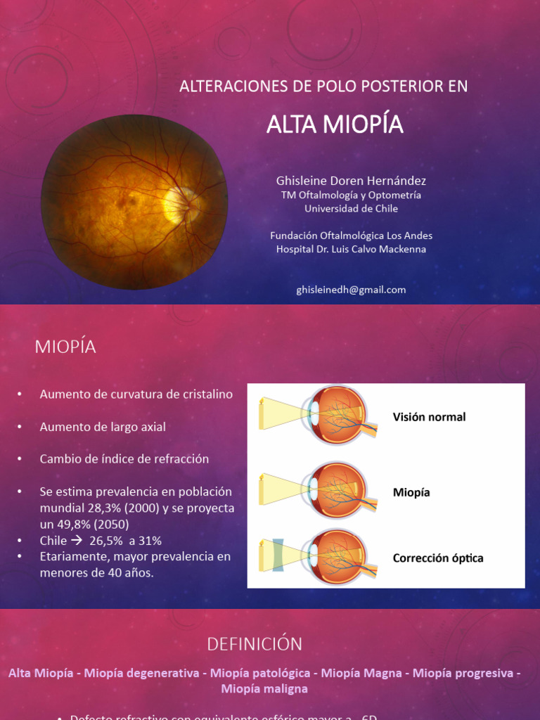 Alteraciones de Polo Posterior en Alta Miopia | PDF | Miopía | Ojo humano