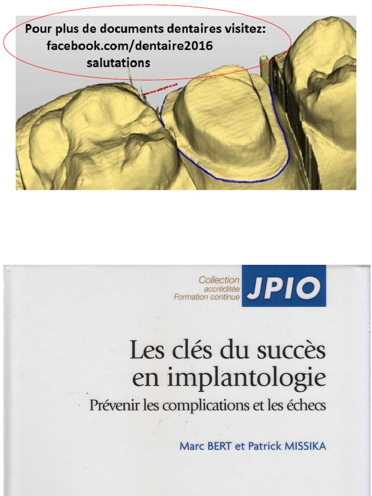 Les Clés de Succés en Implantologie | PDF
