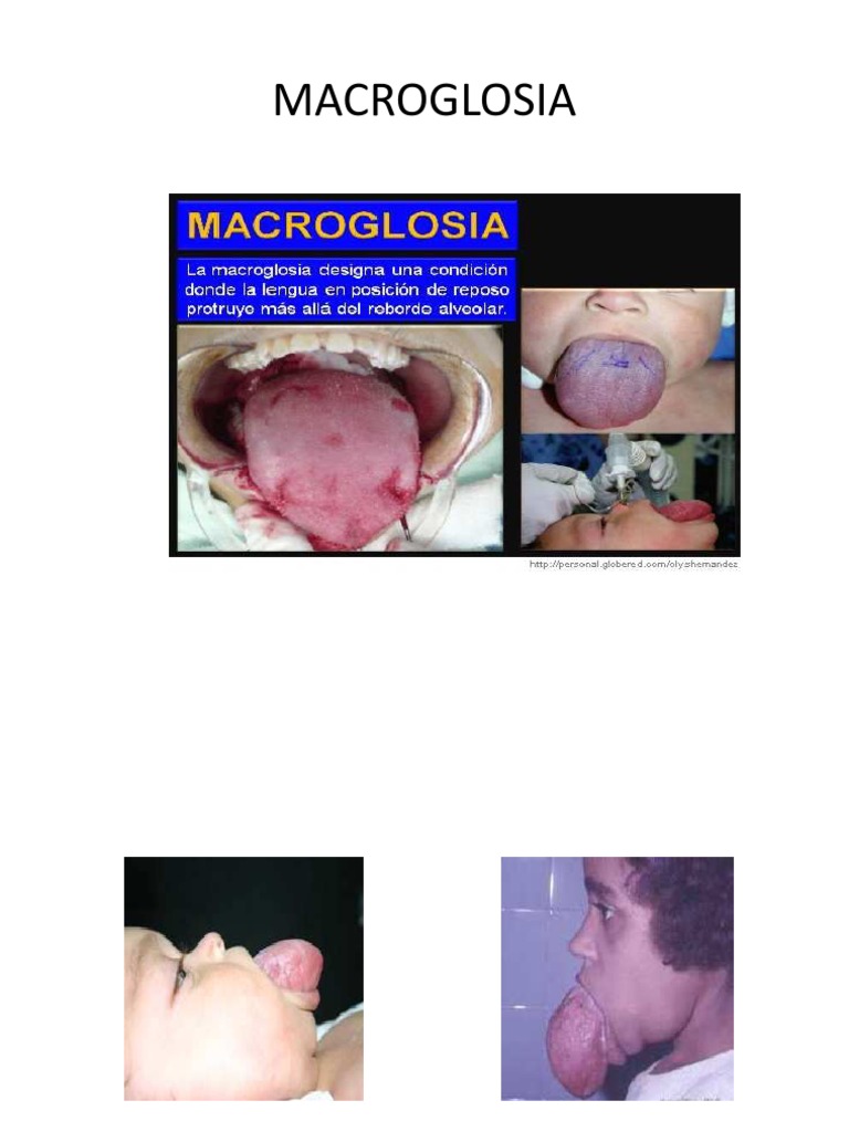 Macroglosia Presentacion 2 | PDF