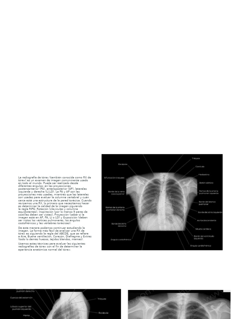 Interpretación de RX | PDF | Pulmón | Tórax