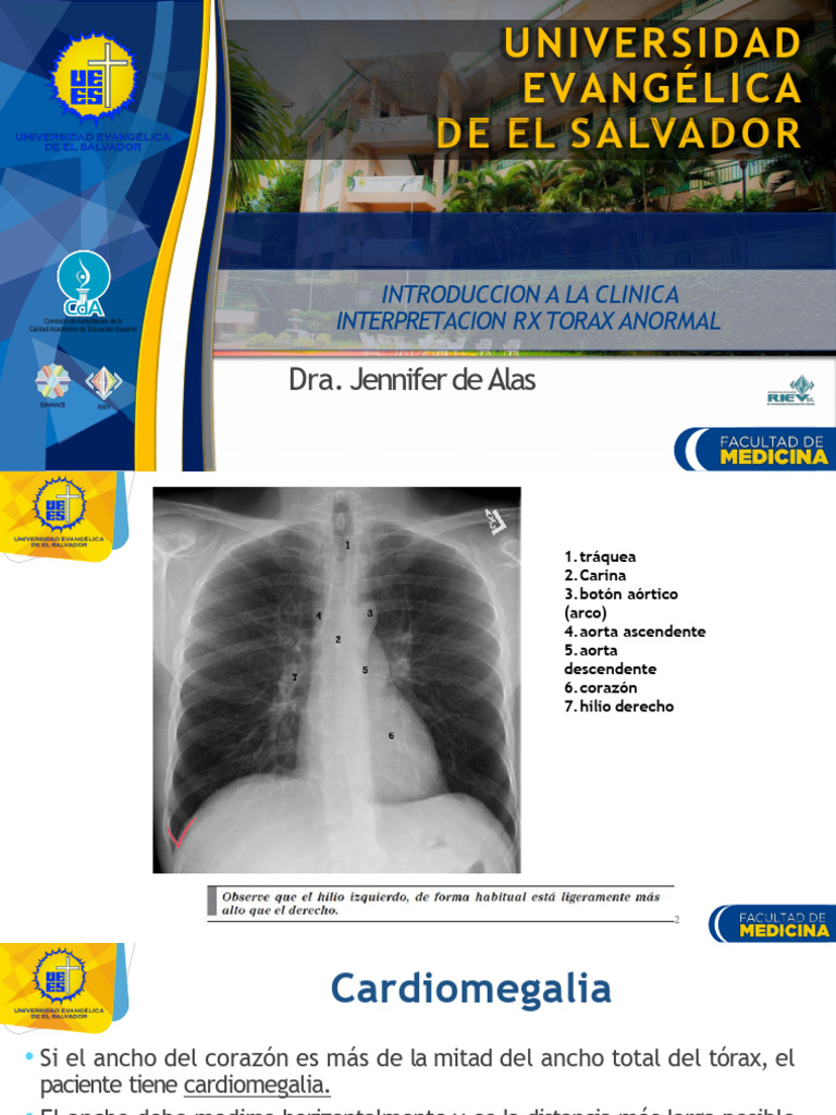 Clase Rayos X de Torax Anormal | PDF | Pulmón | Corazón