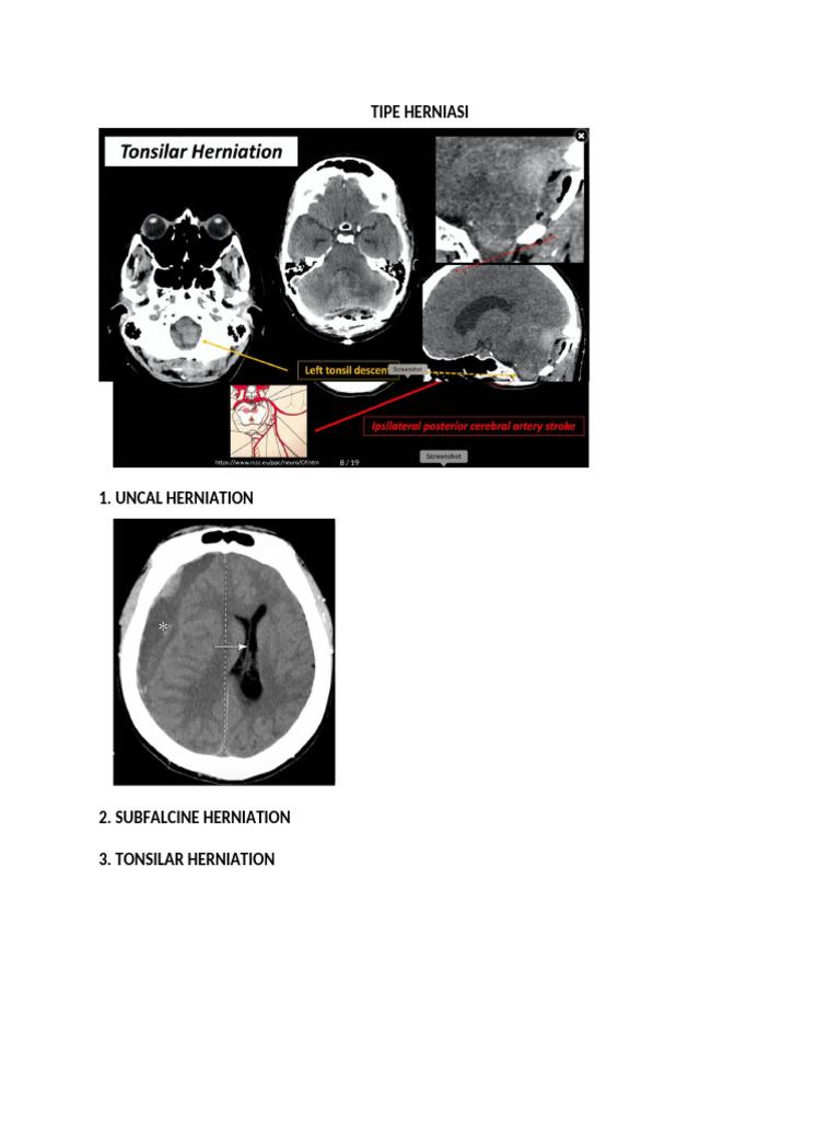 Brain Herniation | PDF