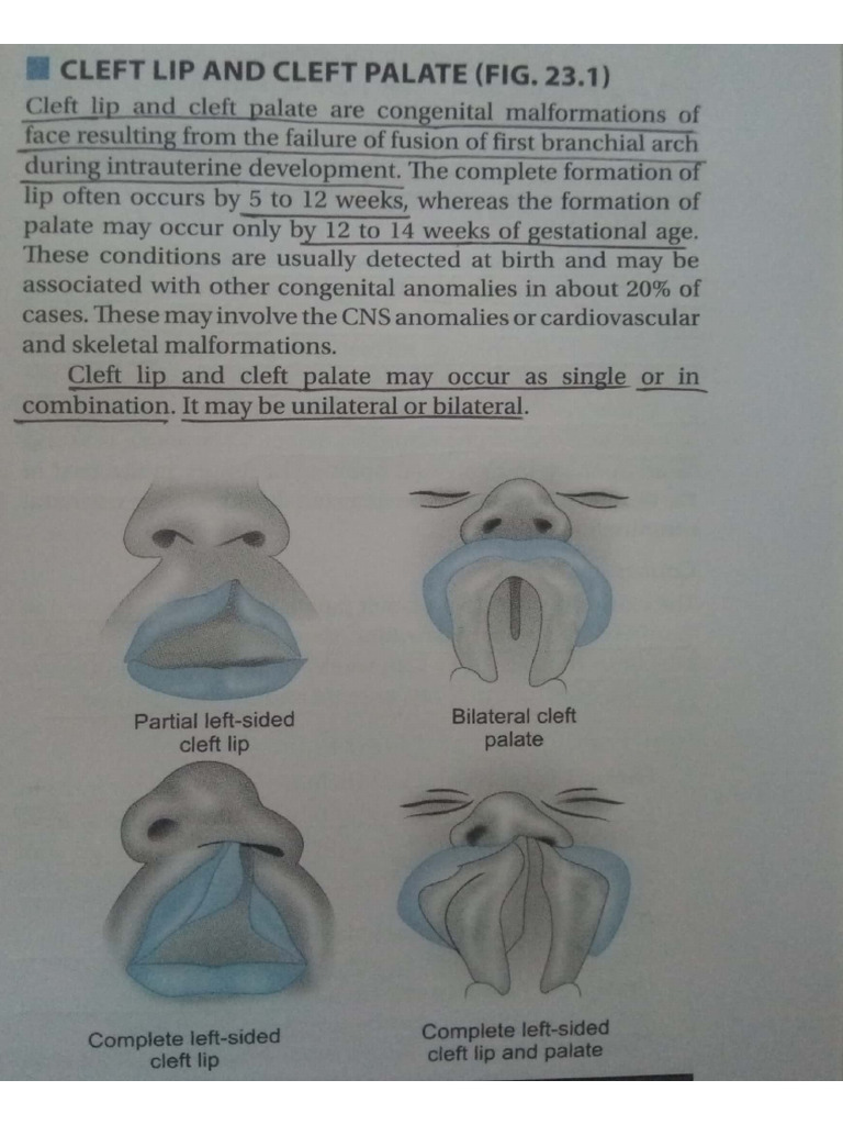 Cleft Lip and Cleft Palate | PDF