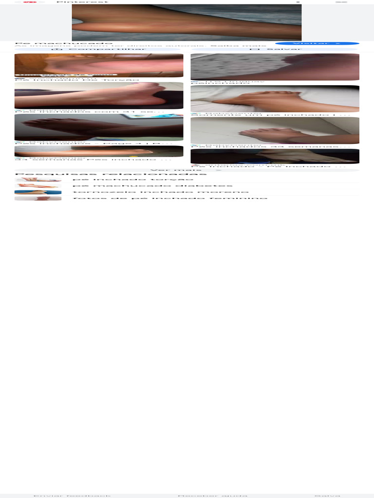 Pé Machucado Inchado - Pesquisa Google | PDF