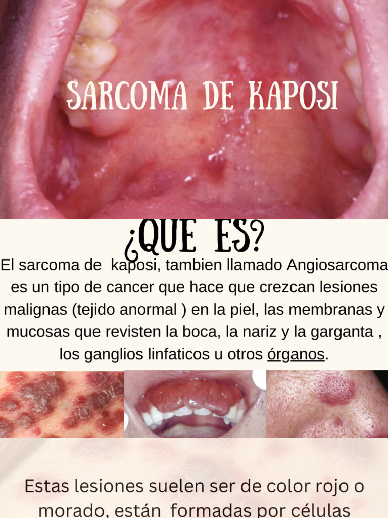 Sarcoma de Kaposi PDF | PDF