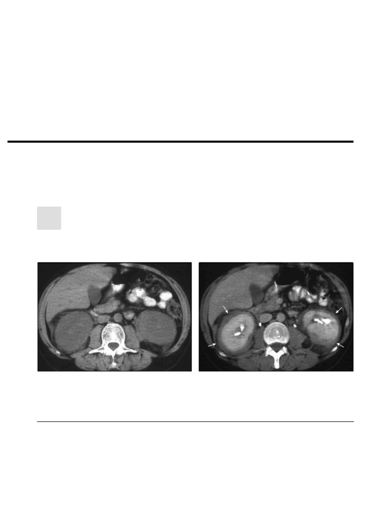Dion Et Al 2012 Imaging of Thoracoabdominal Involvement in Erdheim ...