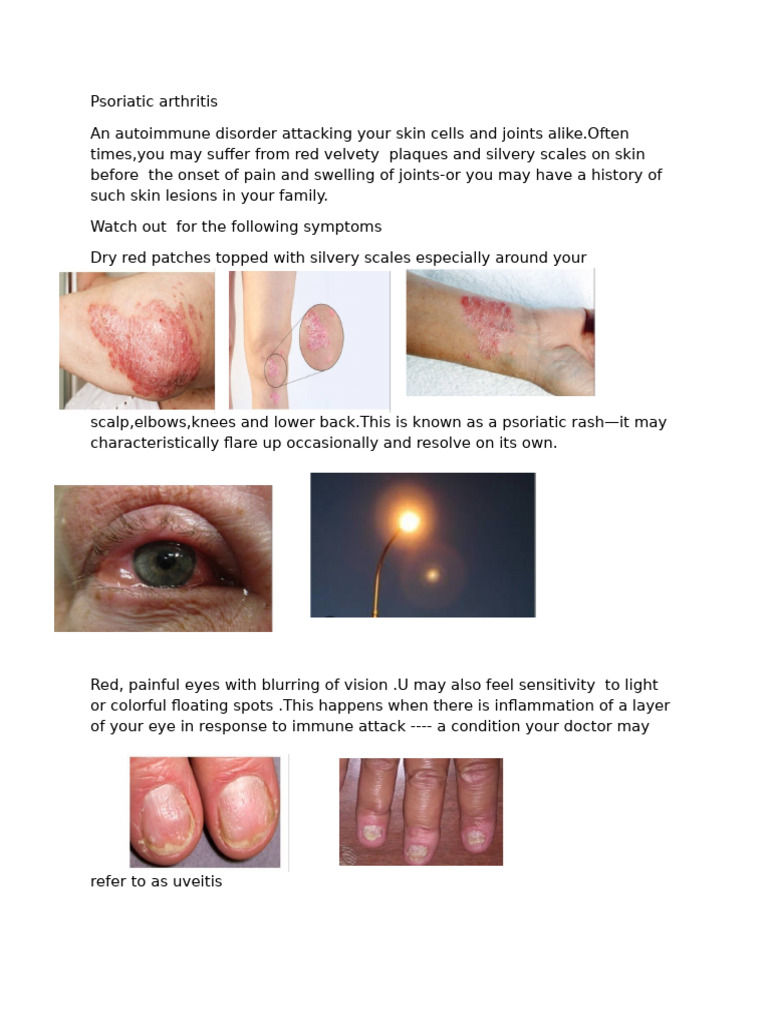 Psoriatic Arthritis | PDF