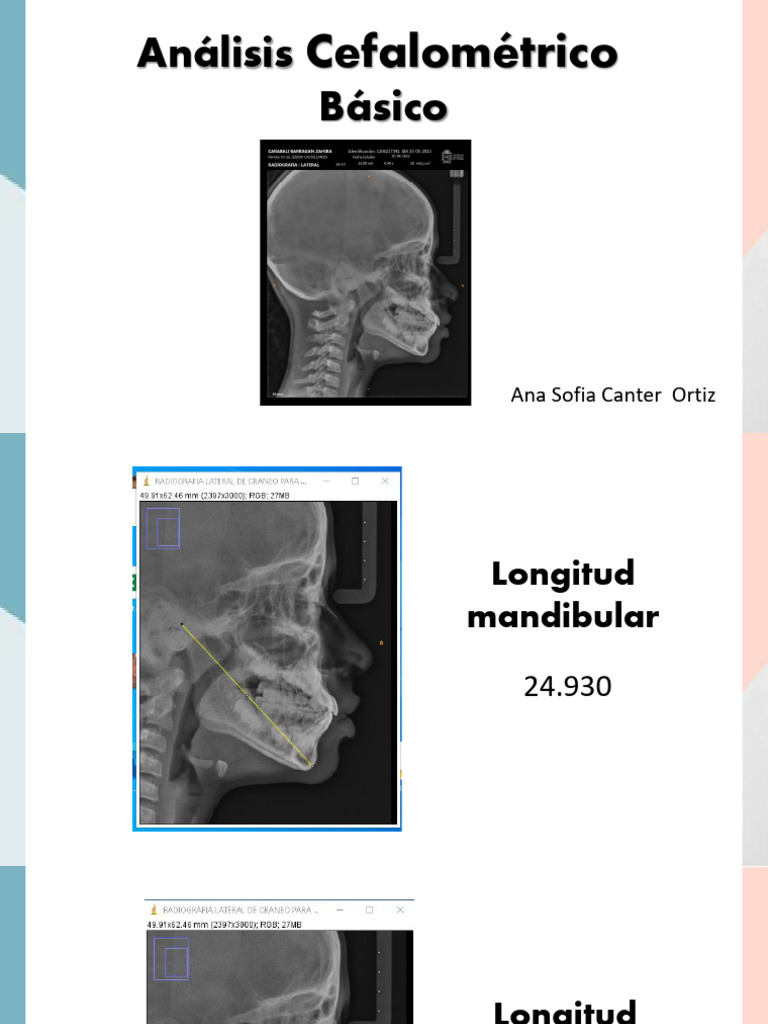 Análisis Cefalométrico: Medidas y Ángulos | PDF
