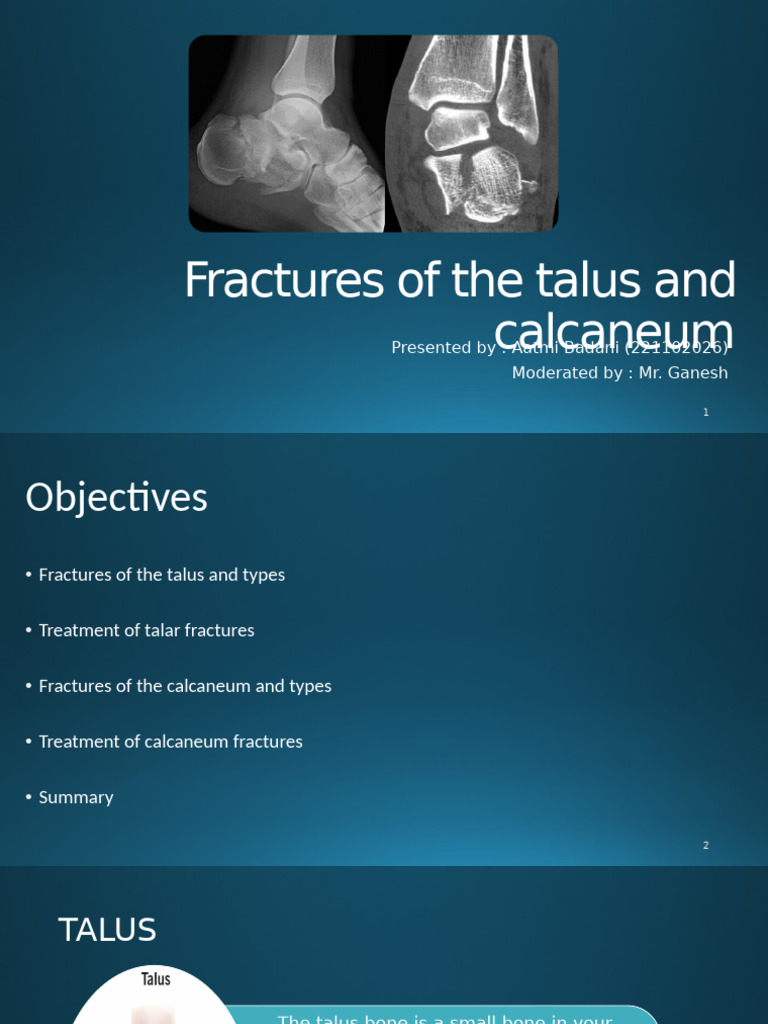 Fractures of The Talus and Calcaneum | PDF | Ankle | Foot