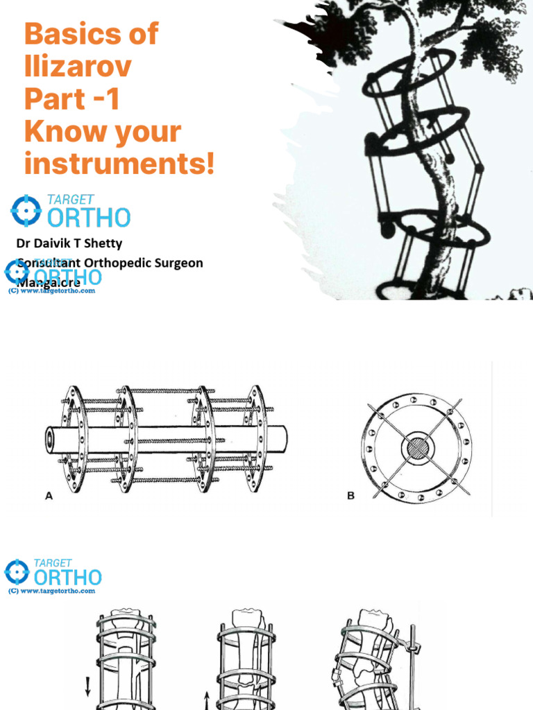 ILIZAROV PART 1 by DR Daivik T Shetty Target Ortho | PDF | Screw | Nut (Hardware)