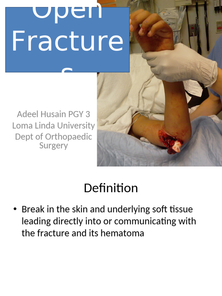 Open Fractures Management | PDF | Wound | Amputation