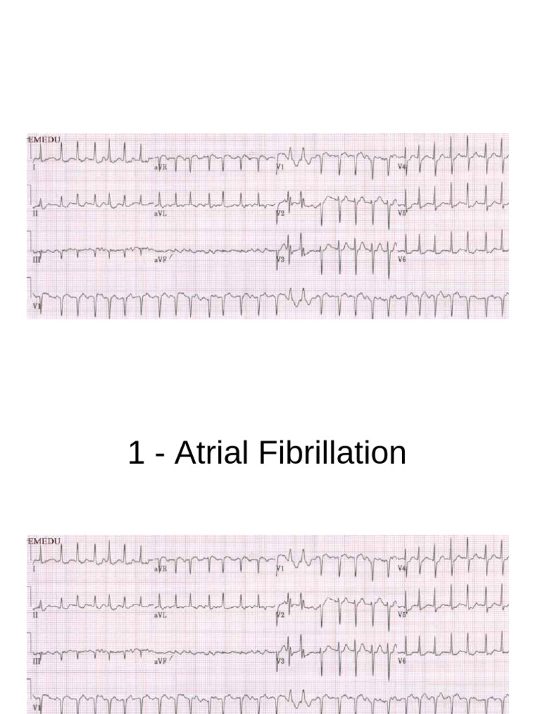 ECG Identification Quiz - SJ | PDF | Electrocardiography | Medical ...