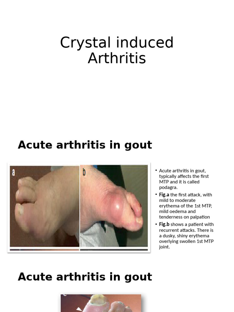 Rheumatology Revision | PDF | Gout | Arthritis