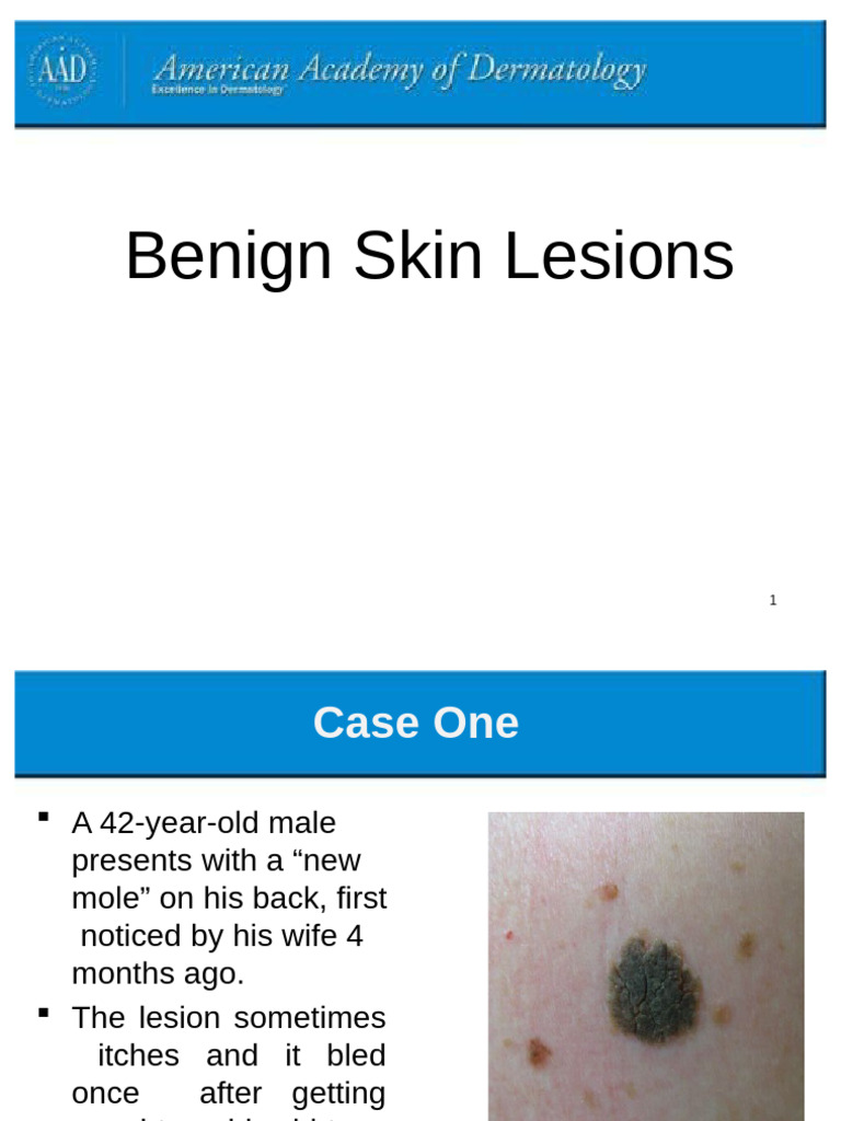 Understanding Benign Skin Lesions | PDF | Cutaneous Conditions | Skin