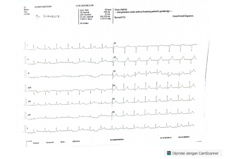 Ecg | PDF