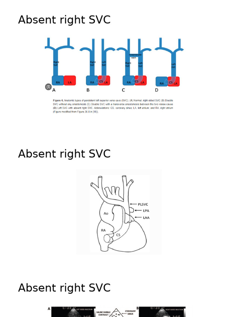 Absent Right SVC and Left SVC Persistence | PDF