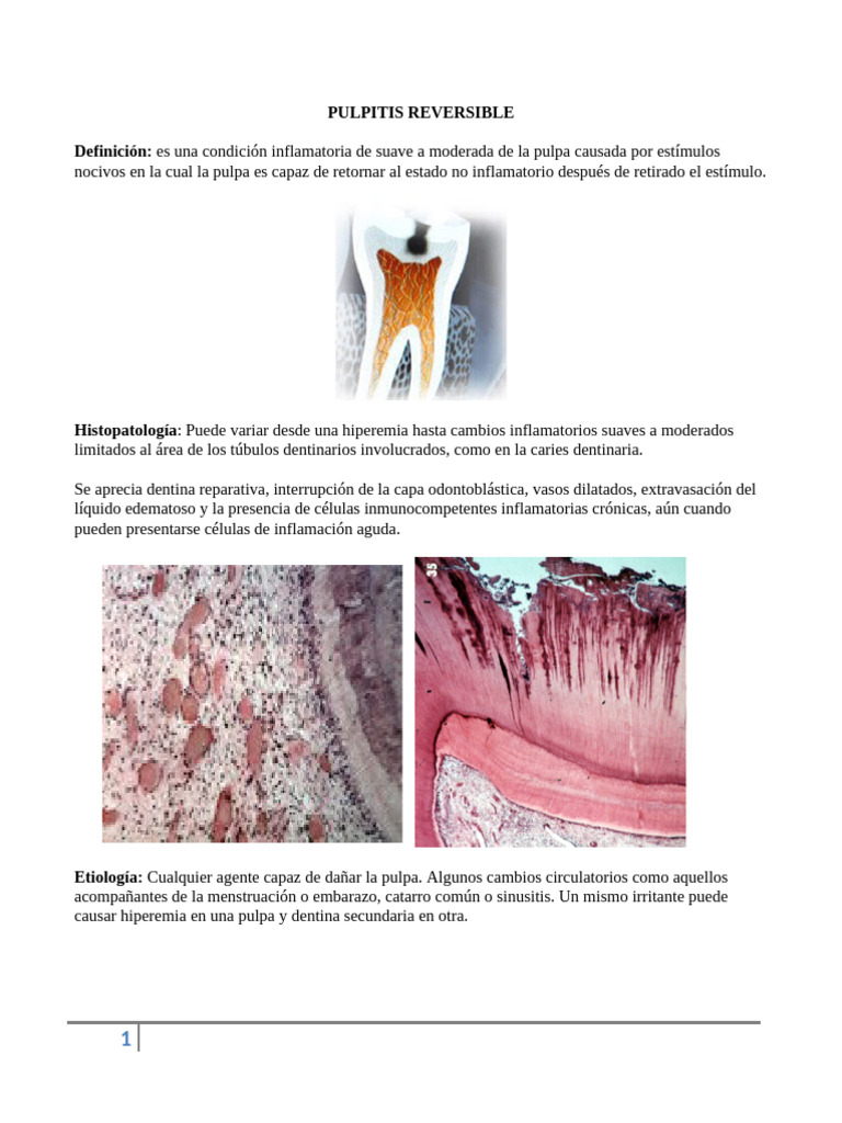 Pulpitis Reversible | PDF | Especialidades Medicas | Medicina CLINICA