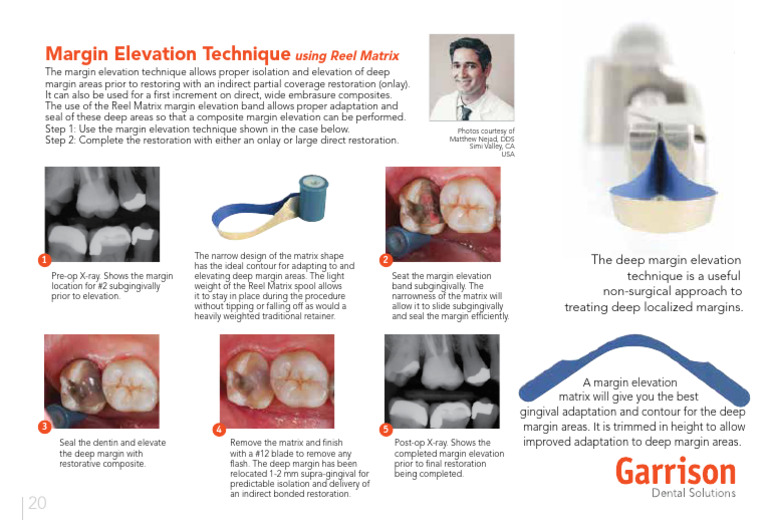 Margin Elevation Band Technique | PDF | Dentistry Branches