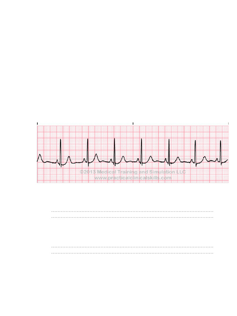 Bahas Soal Latihan EKG Sinus Kls Regular | PDF
