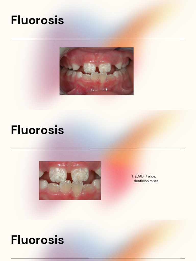 Fluorosis | PDF