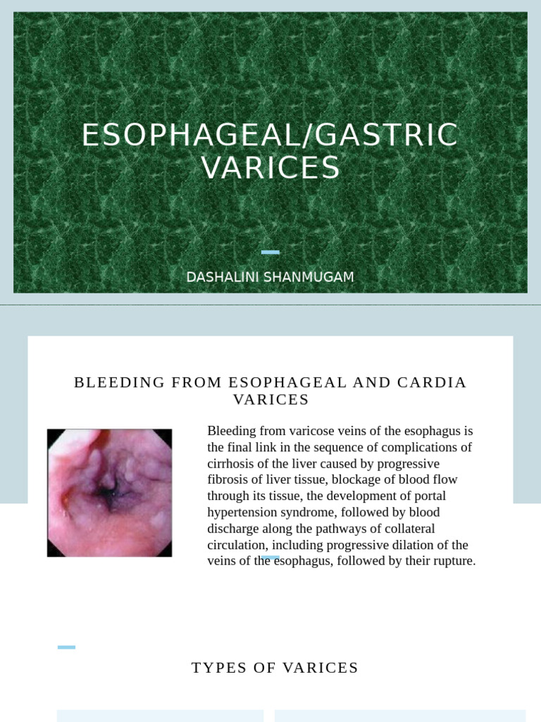 Bleeding of Esophageal Gastric Varices. | PDF | Esophagus | Stomach