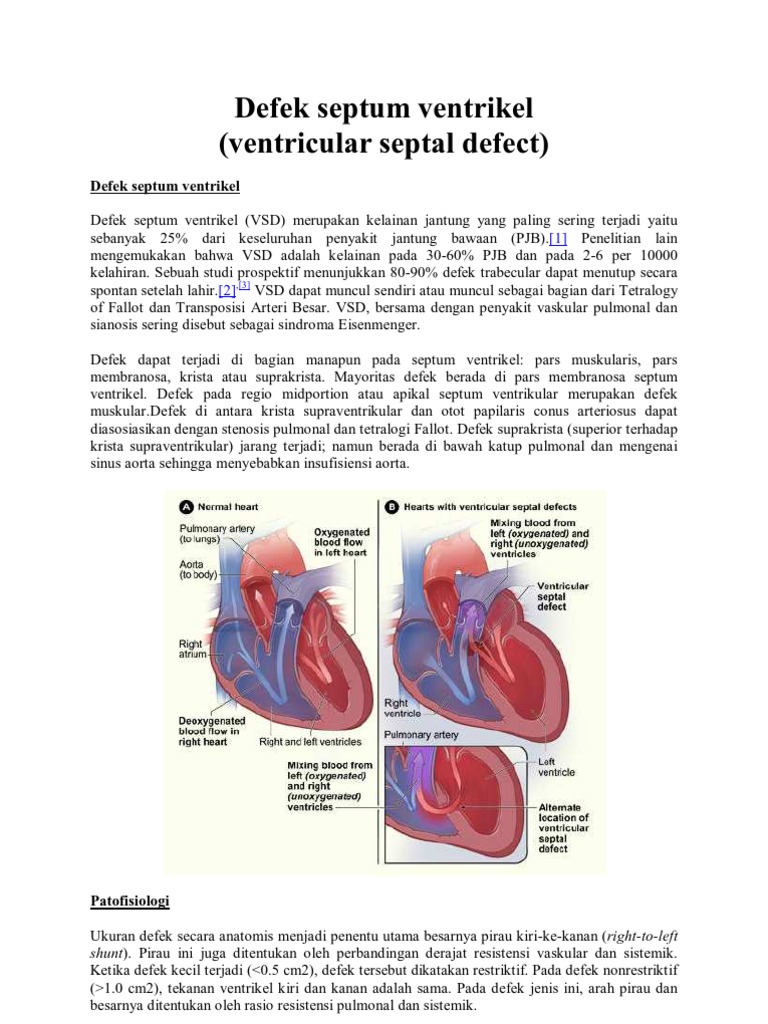 Defek Septum Ventrikel | PDF | Pengembangan Diri | Kesehatan Holistik