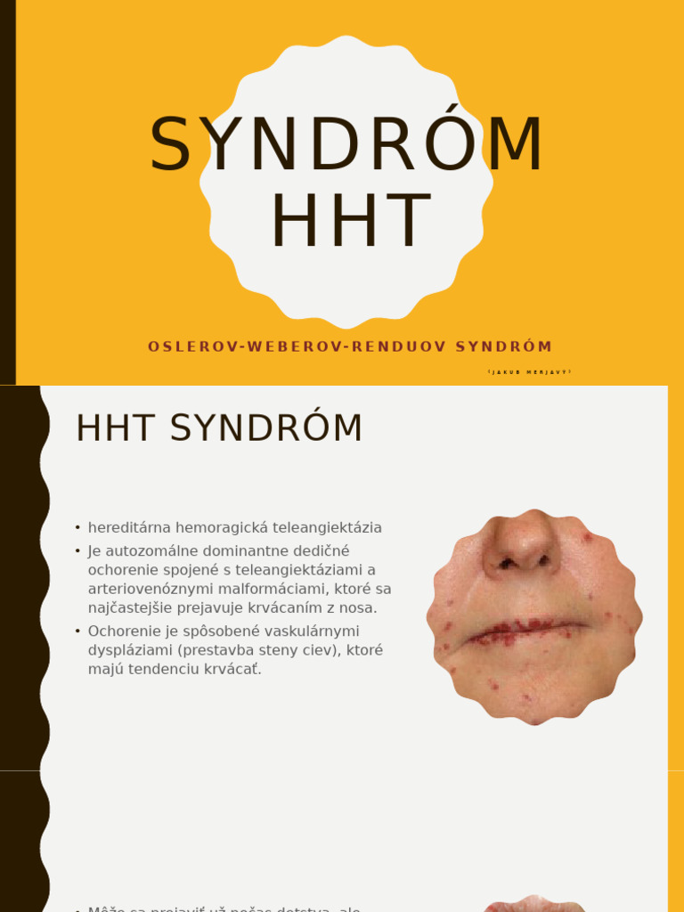 HHT | PDF