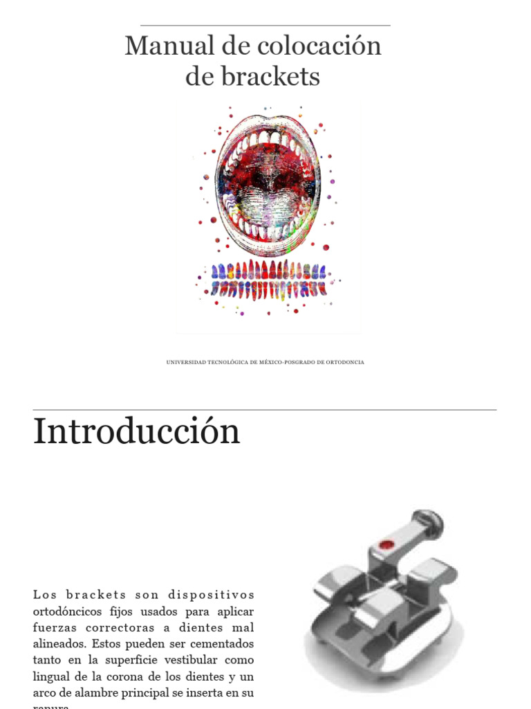 Colocación de Brackets en Ortodoncia | PDF | Diente | Boca