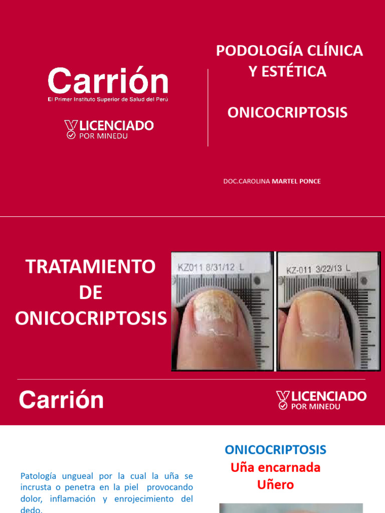 UÑEROS onicocriptosis | PDF | Clavo (anatomía) | Dedo del pie
