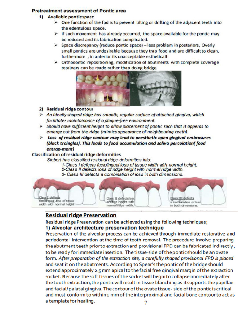 Bridges Pontic | PDF